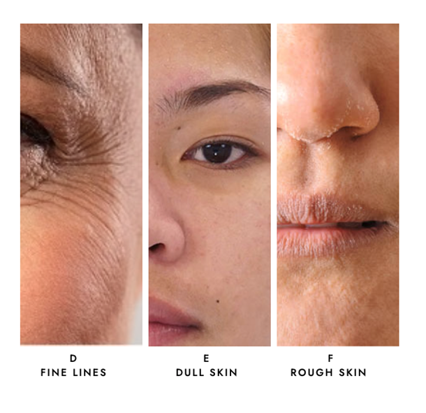 Safe Light and Laser Treatment | Rejuvenate Med Spa