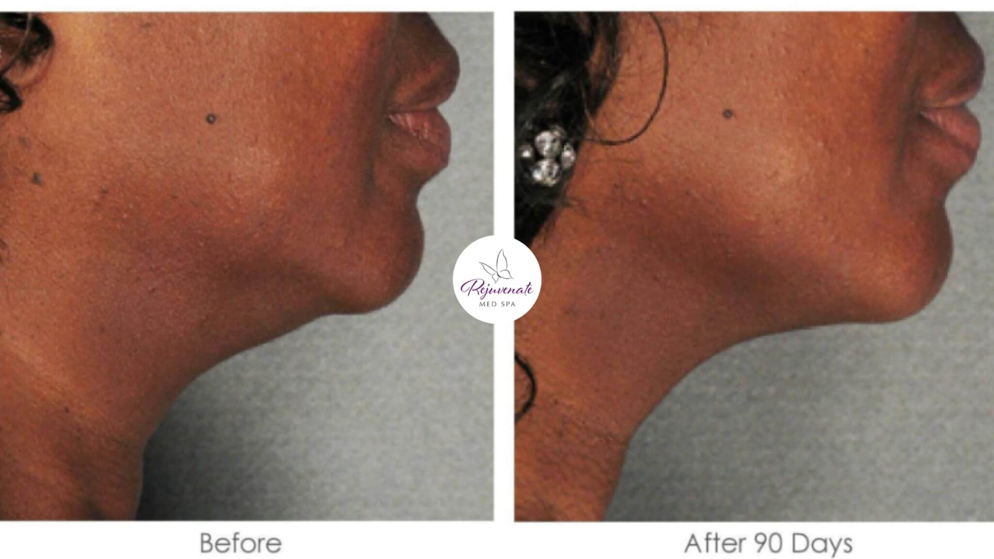What to Expect Before and After Ultherapy Skin Tightening?